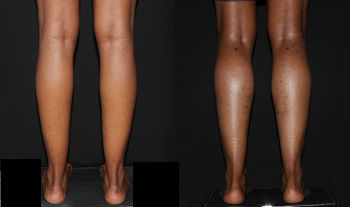 Calf Augmentation Before and After Photos | Dr. Michelle Copeland & Dr ...