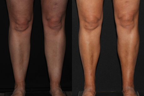 Liposuction for Knee Calf & Ankle in NYC | Dr. Copeland & Copeland-Halperin